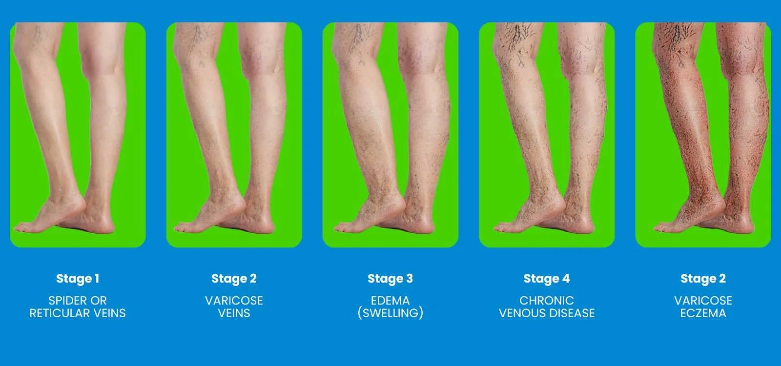 Best Compression Stockings for Varicose Veins - Rosen Vein Care
