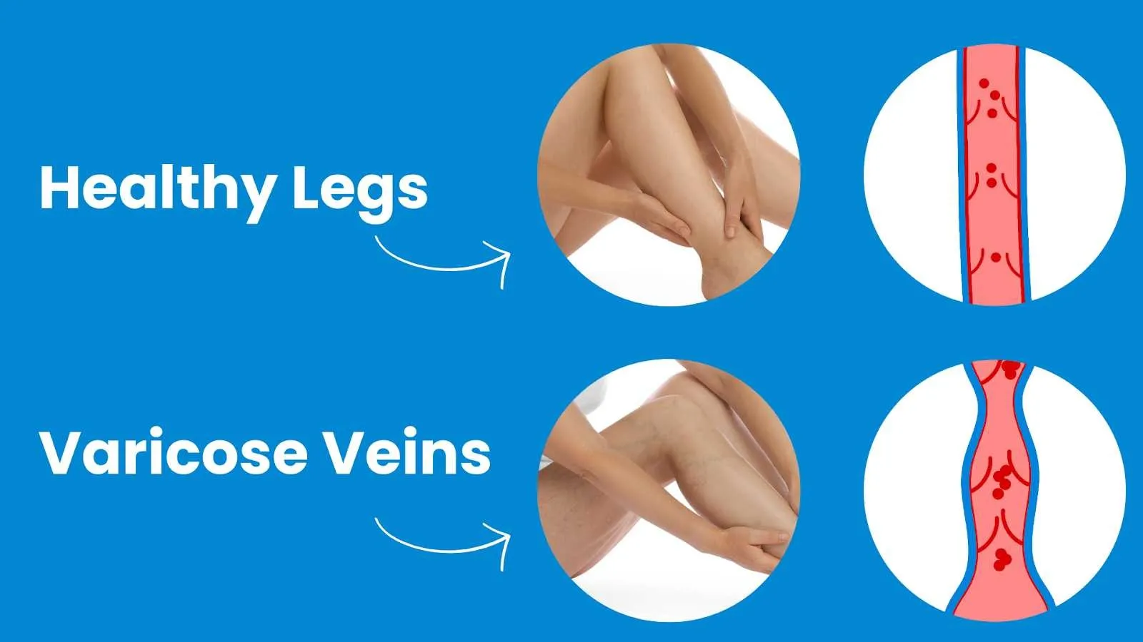 The Best Diet for Venous Insufficiency - Rosen Vein Care